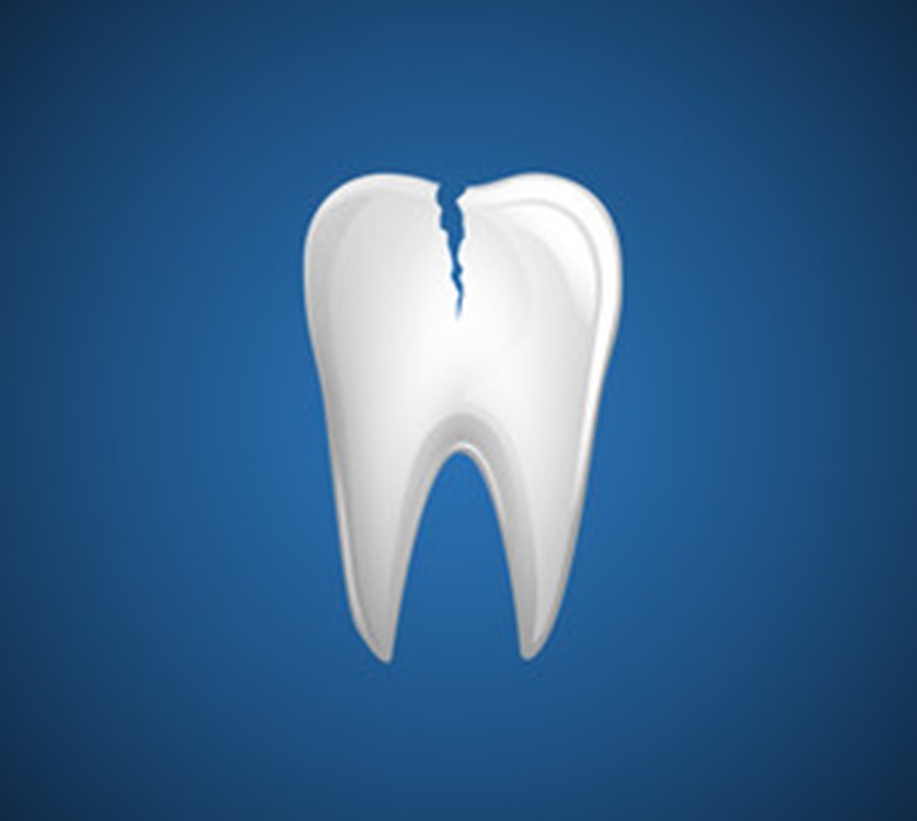 Chipped Tooth | Temple Dentist | Temple Choice Dental